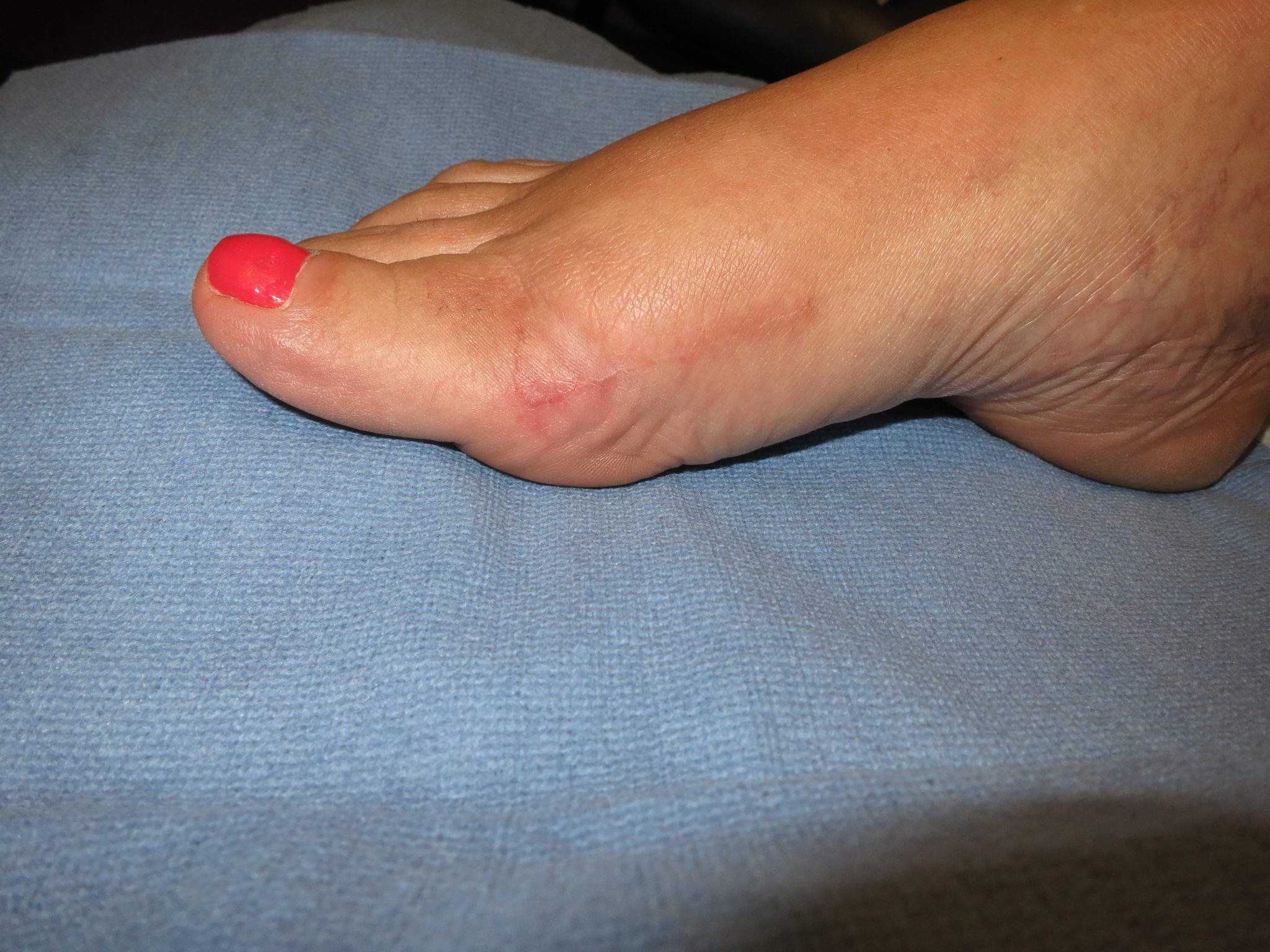 Scarf bunionectomy. Often, the best bunion surgery procedure!