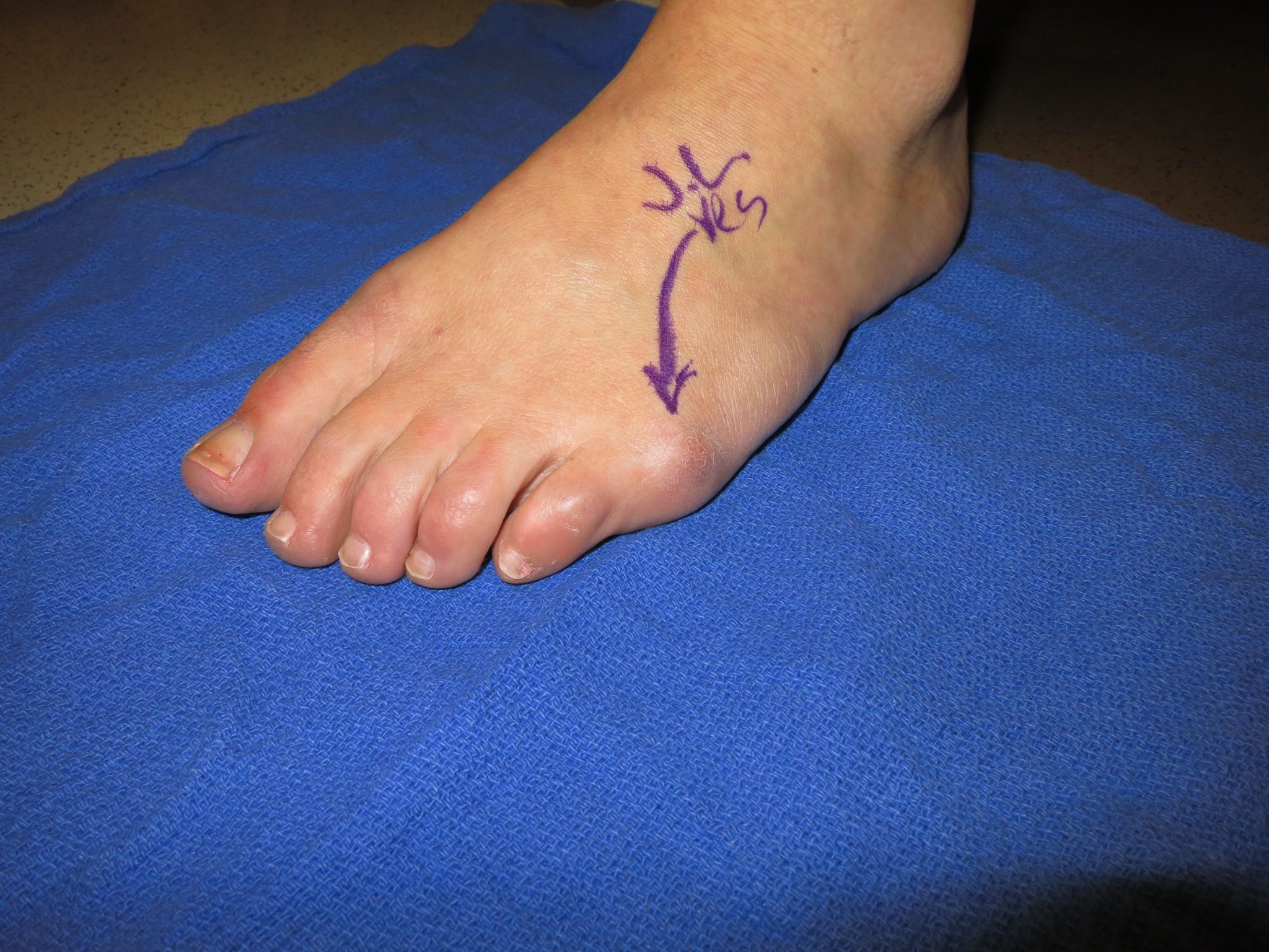 Tailor's Bunion Surgery: A Transformative Journey at Citi Footcare ...