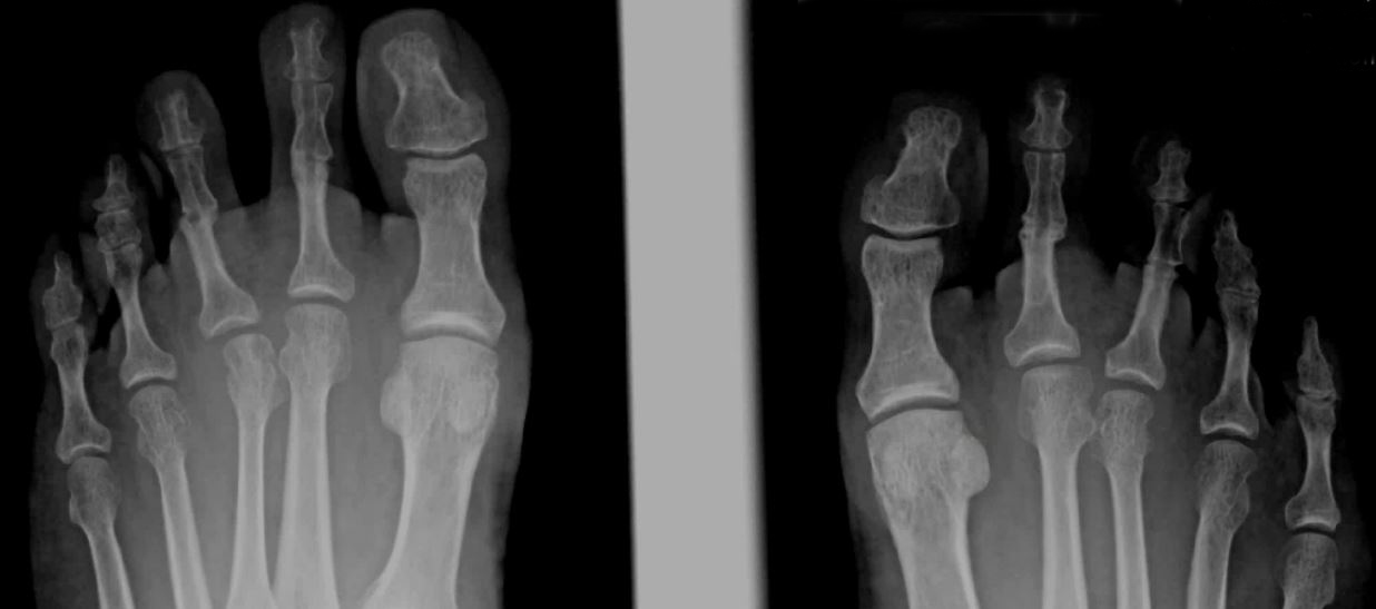 Going Toe-to-Toe: Fusion vs. Arthroplasty for Hammertoe + Case study of ...