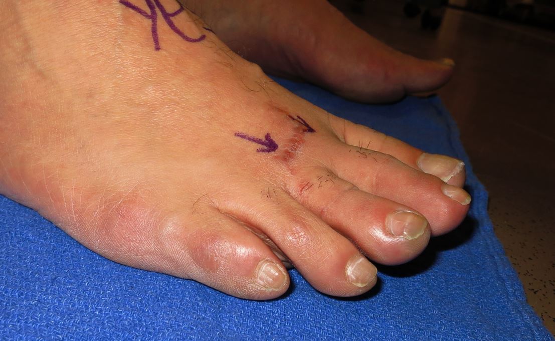 Going Toe-to-Toe: Fusion vs. Arthroplasty for Hammertoe + Case study of ...