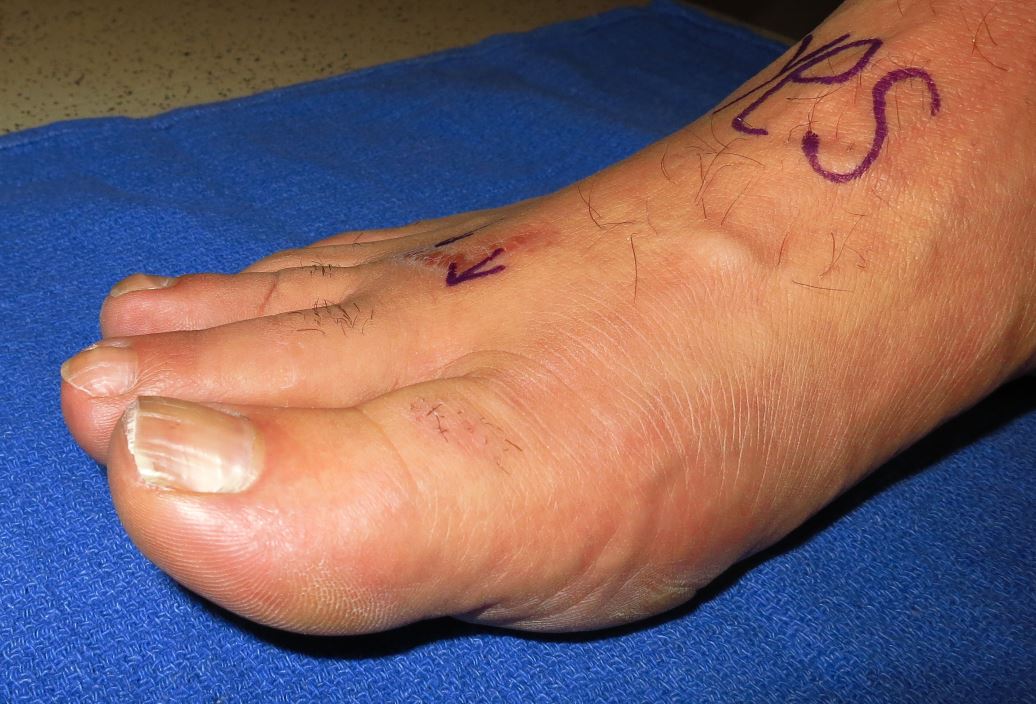 Going Toe-to-Toe: Fusion vs. Arthroplasty for Hammertoe + Case study of ...