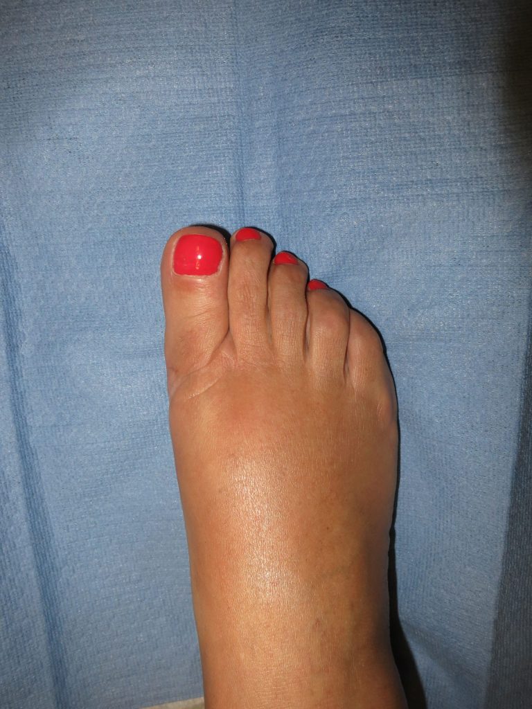 Bunion Corrector Surgery Grand Central NYC | Dr. Emanuel Sergi